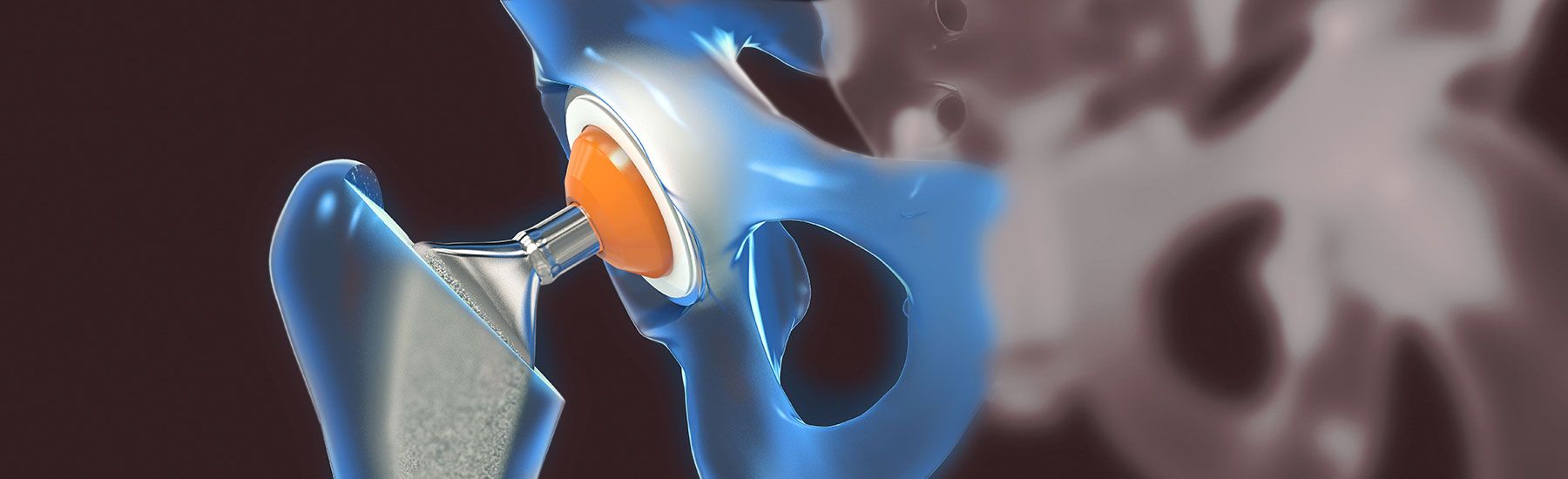 Faulty Medical Device Claims | Digby Brown